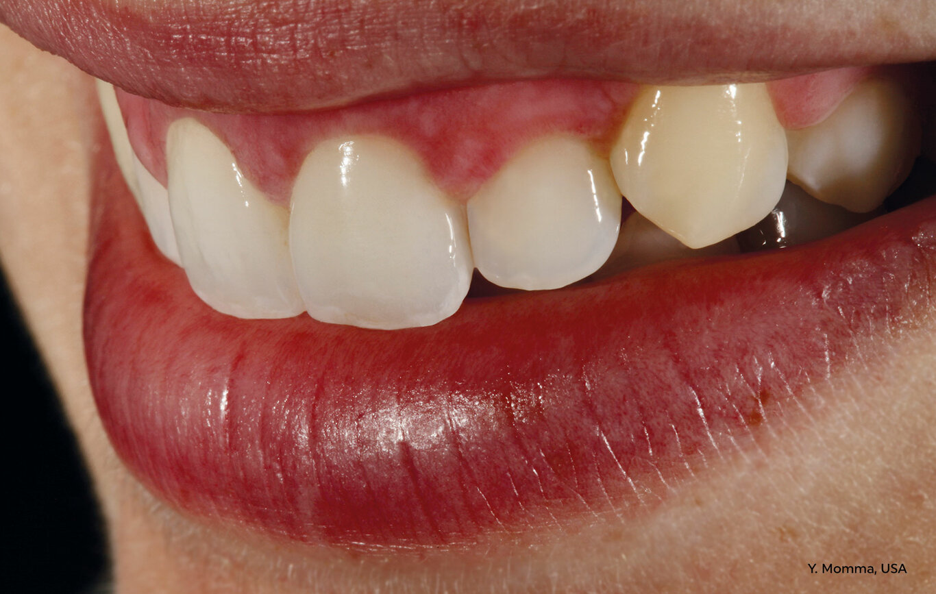 IPS e.max ZirCAD Prime | Zirconia Restorations | Ivoclar